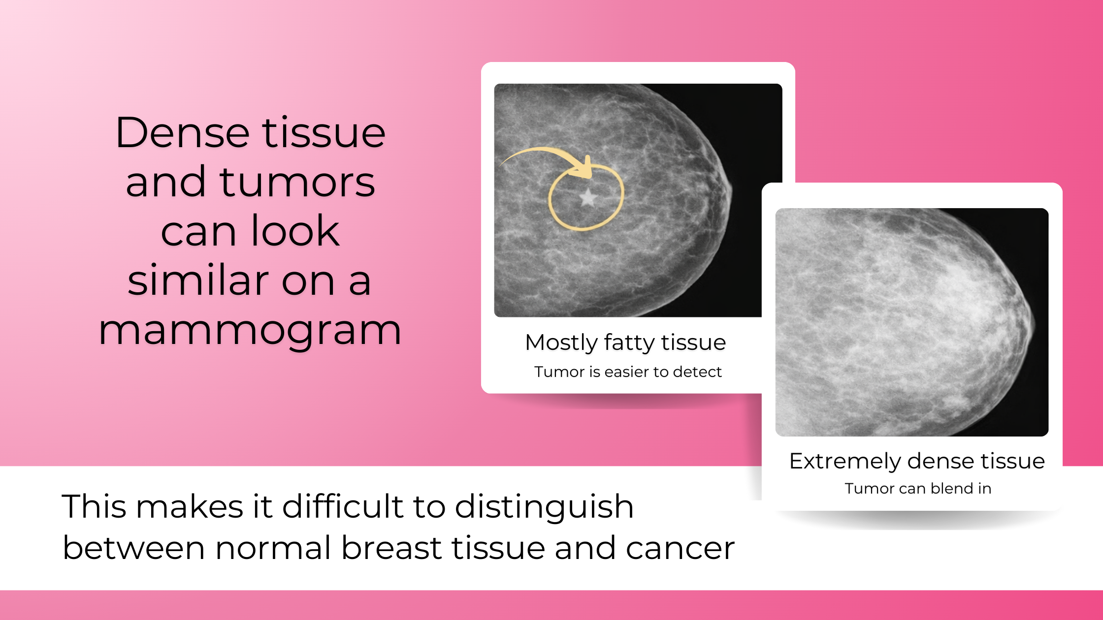 Is Heterogeneously Dense Breast Tissue Dangerous?